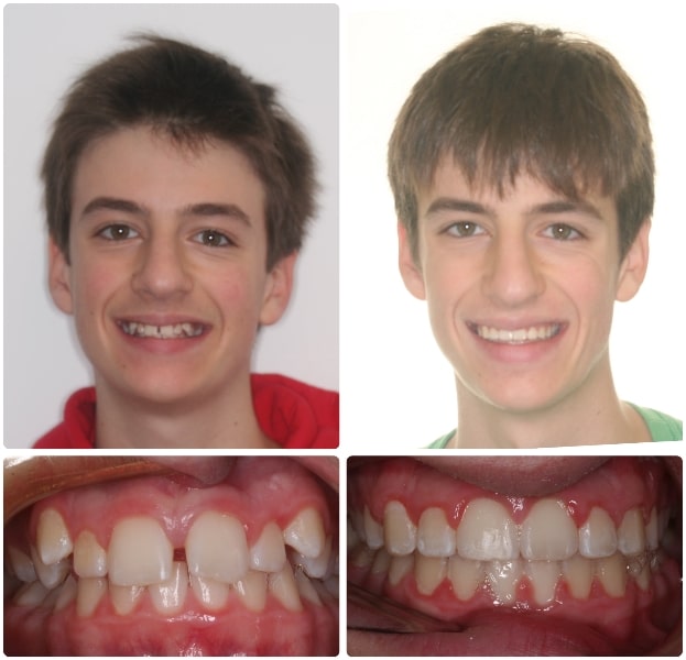 Before and After Orthodontic Results | Southern Maine Orthodontics
