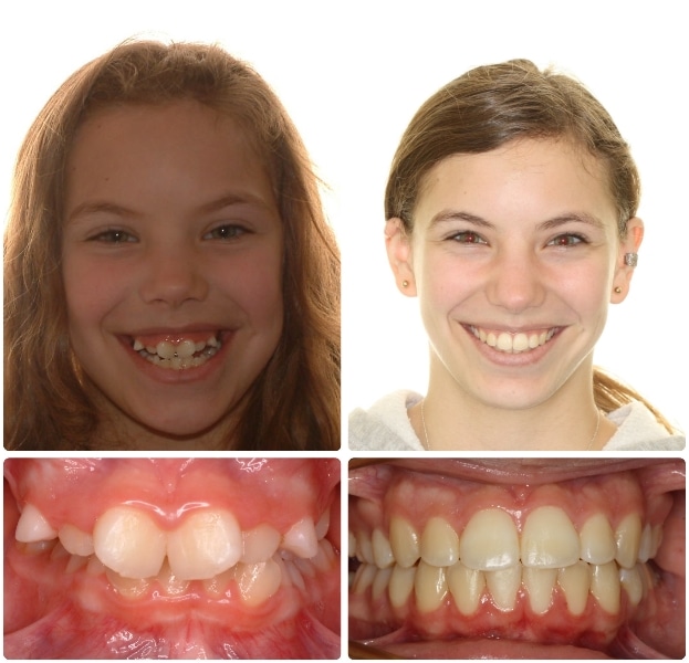 Before and After Orthodontic Results | Southern Maine Orthodontics