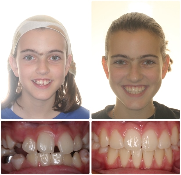Before and After Orthodontic Results | Southern Maine Orthodontics