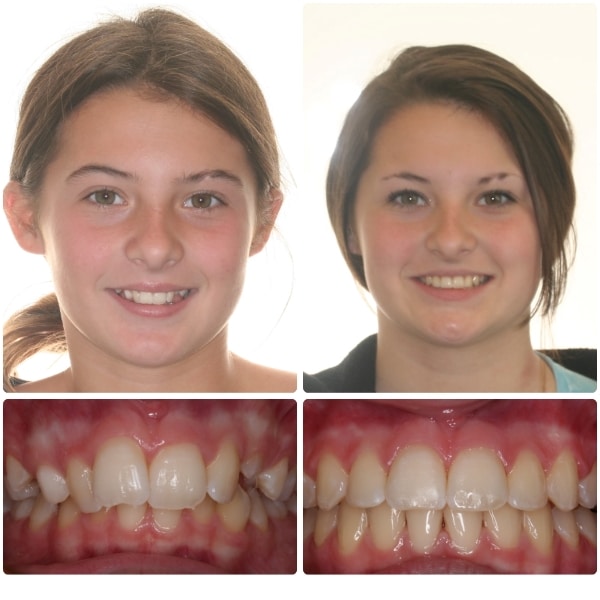 Before and After Orthodontic Results | Southern Maine Orthodontics