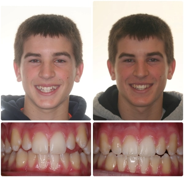 Before and After Orthodontic Results | Southern Maine Orthodontics
