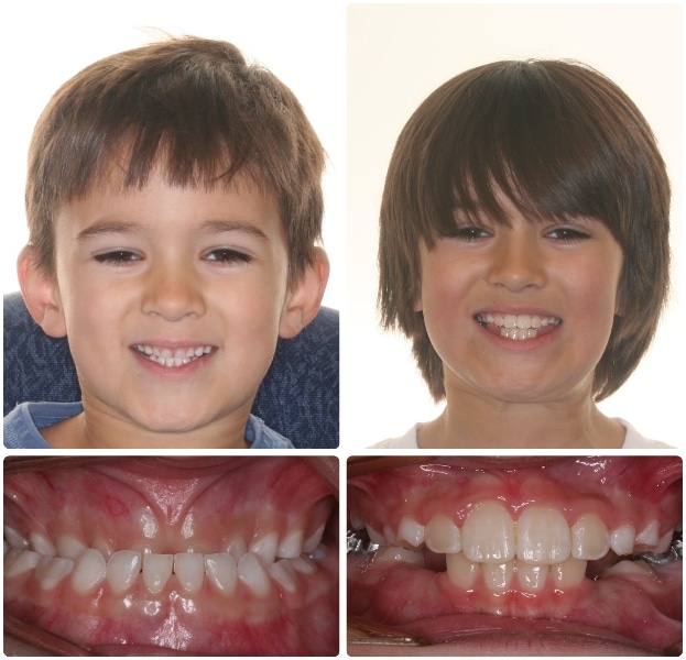 Before and After Orthodontic Results | Southern Maine Orthodontics